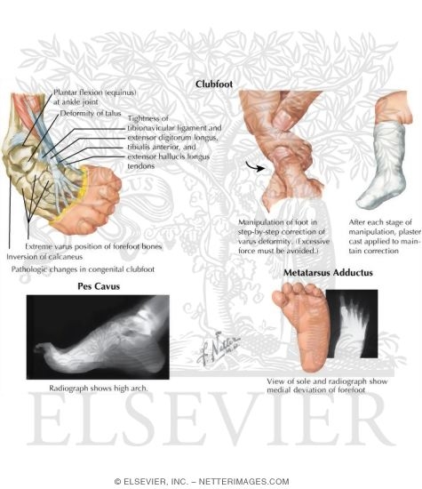 Pediatric Disorders of the Foot and Ankle