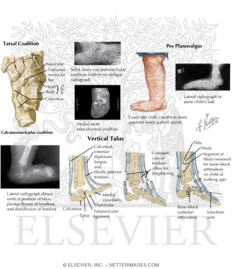 Pediatric Disorders of the Foot and Ankle