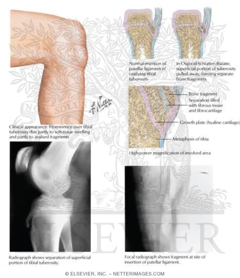 Osgood-Schlatter Lesion