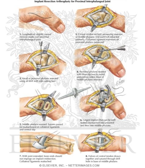 excision arthroplasty