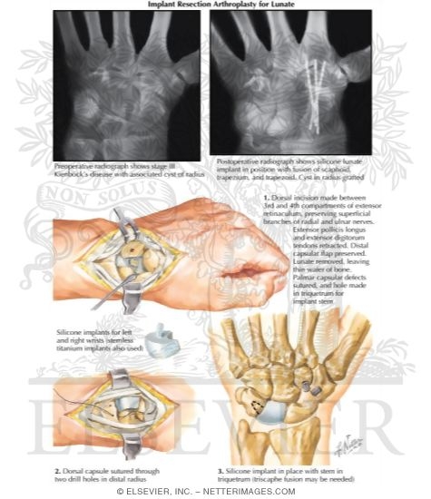 excision arthroplasty