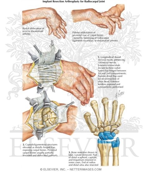 Radiocarpal joint - meddic