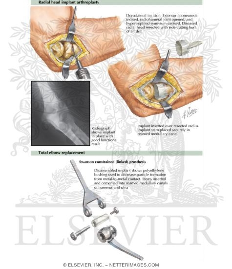 Radial Head Implant Arthroplasty - Total Elbow Replacement
