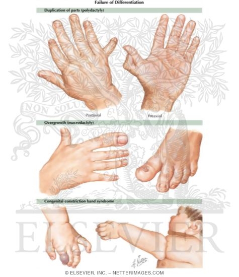 Duplication of Parts (polydactyly), Overgrowth (macrodactyly), and ...