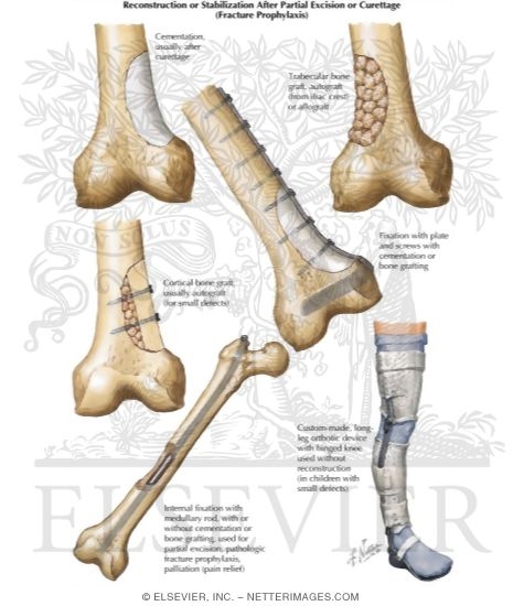 Reconstruction or Stabilization After Partial Excision or Curettage ...