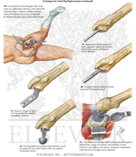 Technique for Total Hip Replacement