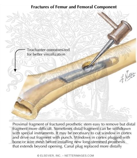 Fractures of Femur and Femoral Component