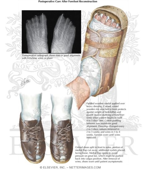 Postoperative Care After Forefoot Reconstruction