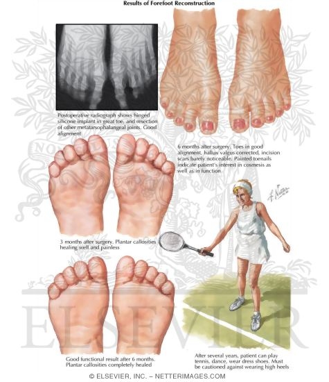 Results of Forefoot Reconstruction Results of Forefoot Reconstruction