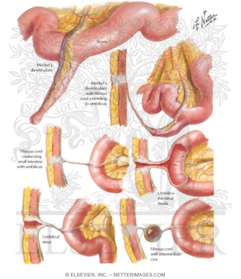 meckel's diverticulum