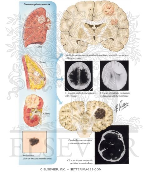 Tumors Metastatic to Brain