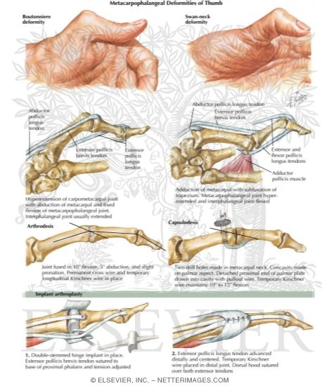 Metacarpophalangeal Deformities of Thumb