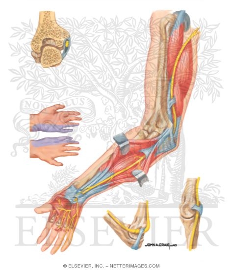 Ulnar Nerve Compression In the Cubital Tunnel