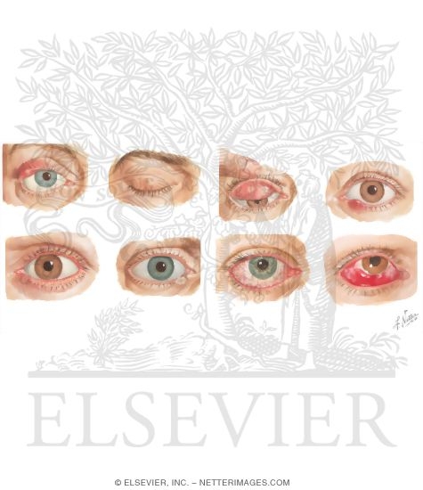 Eyelid Infections and Conjunctival Disorders