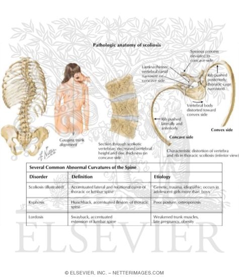 Accentuated Spinal Curvatures