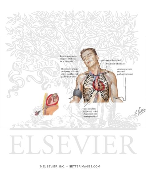 Right Atrium and Ventricle