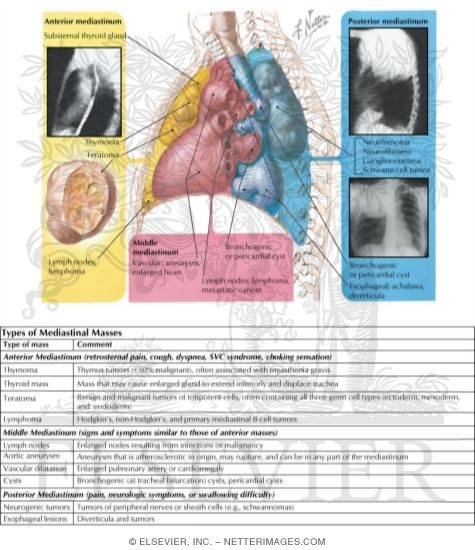 Tumors of Mediastinum