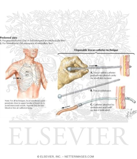 Transurethral Resection of Bladder Tumor: Procedure (Continued)