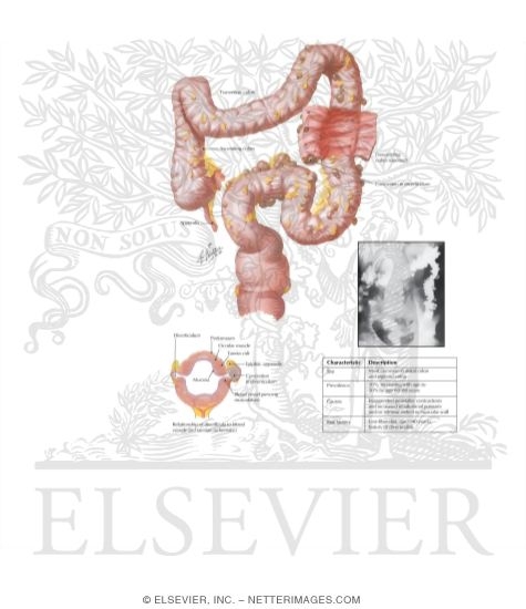 Diverticulosis