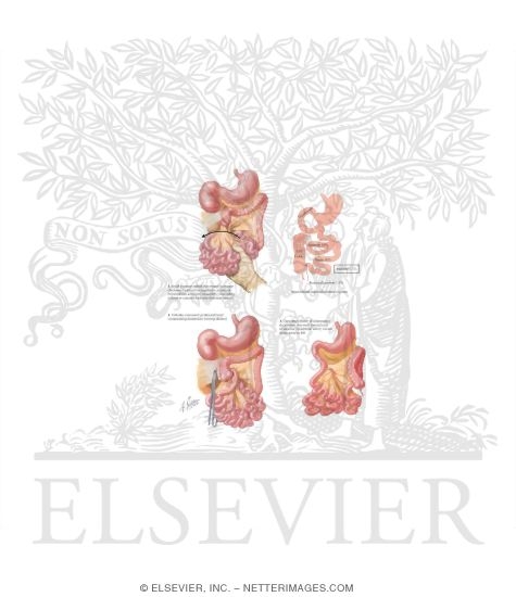 Congenital Intestinal Abnormalities, Including Malrotation of the Colon ...