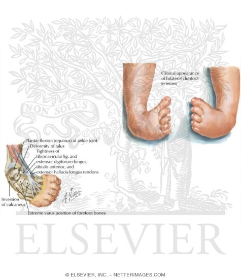 Congenital Clubfoot