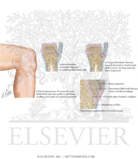 Osgood-Schlatter Lesion