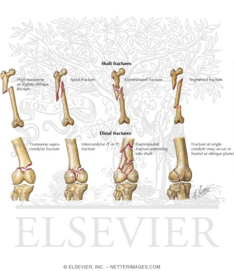 Fractures of the Shaft and Distal Femur