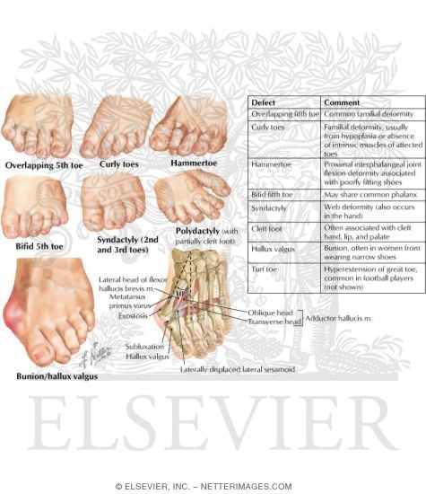 Toe Deformities