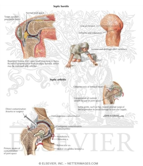 Septic Bursitis and Arthritis