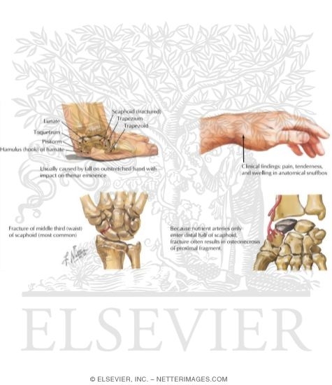 Fracture of Scaphoid