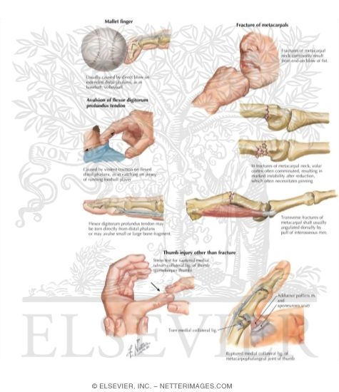 Finger Injuries