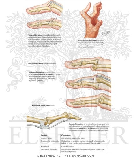 Proximal Interphalangeal Joint Dislocations
