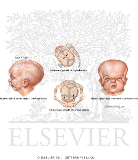 Premature Suture Closure