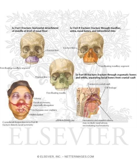 Midface Fractures