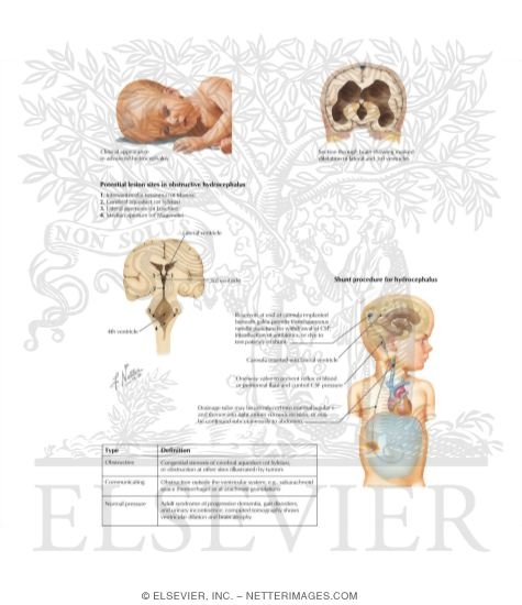 Hydrocephalus