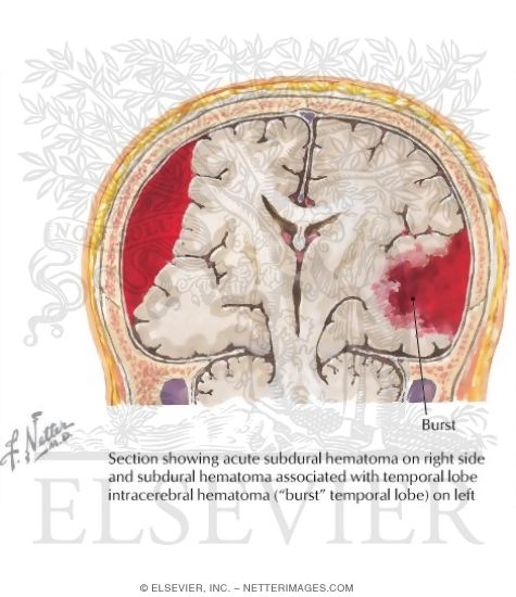Subdural Hematomas