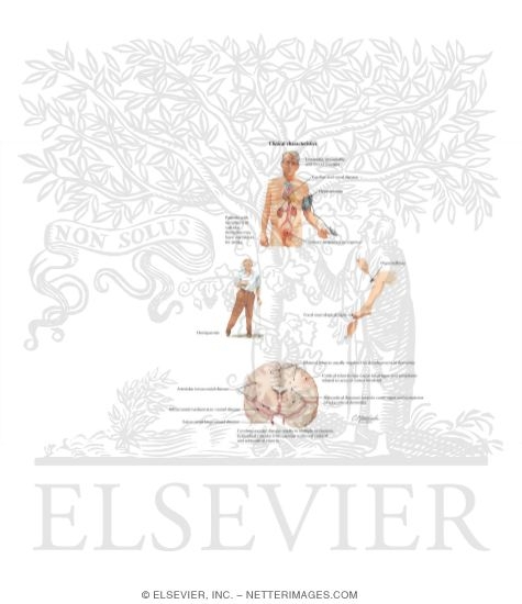 Vascular (Multi-Infarct) Dementia