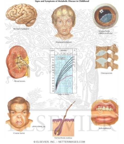 Birth Defects: Signs and Symptoms of Metabolic Disease In Childhood