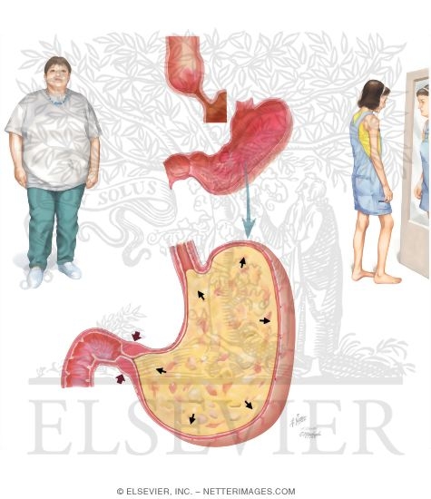 Gastroparesis and Gastric Motility Disorders