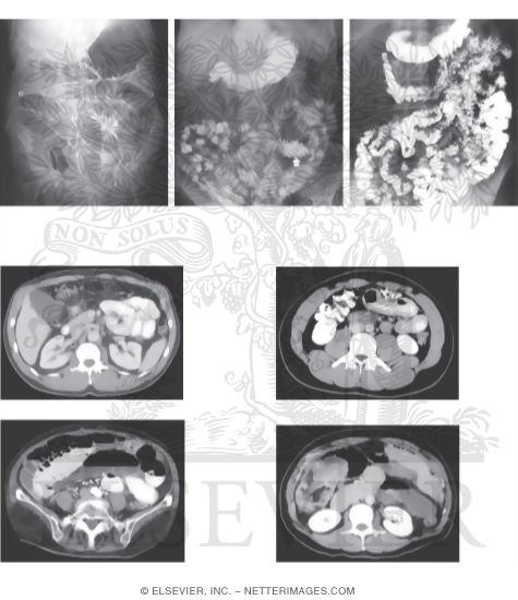 Imaging Studies of the Small Intestine