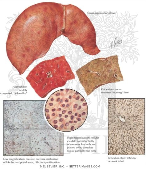 Viral Hepatitis: Fulminant Form (Acute Massive Necrosis)