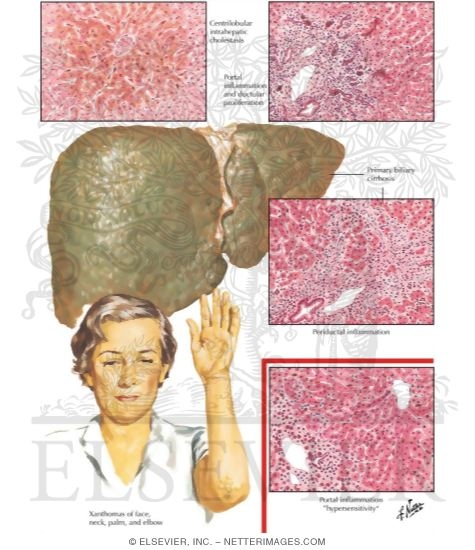 Intrahepatic Cholestasis