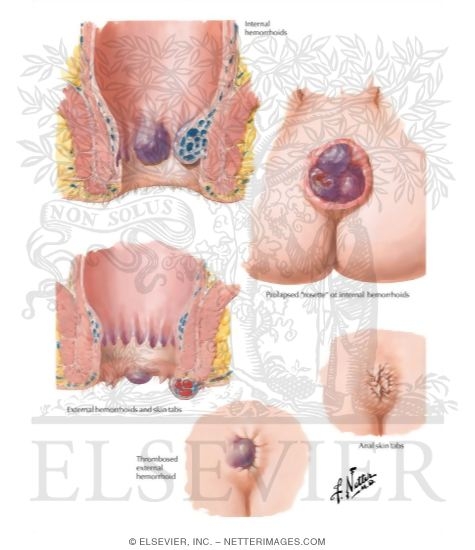 difference between rectal prolapse and hemorrhoids