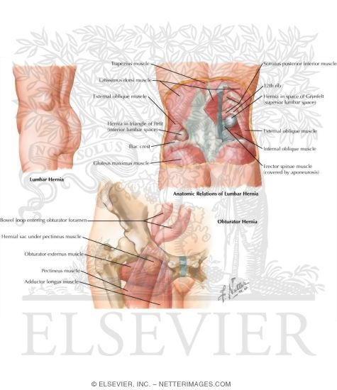 sciatic hernia icd 10
