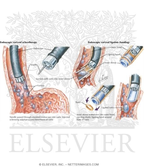Variceal Bleeding: Ligation Techniques