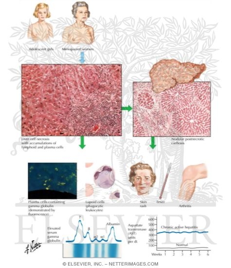 Autoimmune Hepatitis