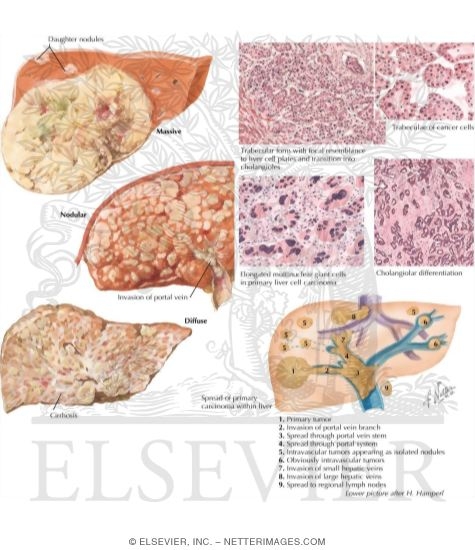 Hepatocellular Carcinoma: Gross and Histologic Features and Spread of ...