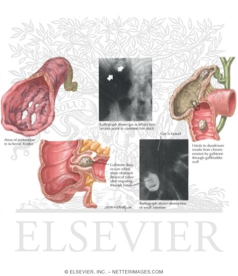 Complications of Cholecystitis