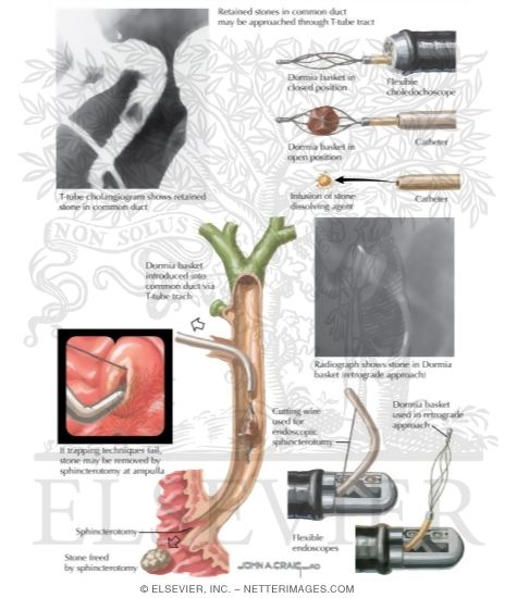 Choledocholithiasis and Cholangitis: Management of Stones