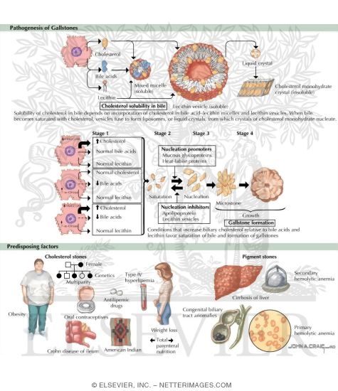 Pathogensis of Gallstones